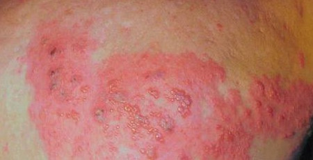 Proč je pásový opar závažnější u seniorů?