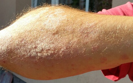 Lupénka a její vyléčení stravou a správným dýcháním