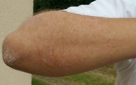 Lupénka a její vyléčení stravou a správným dýcháním